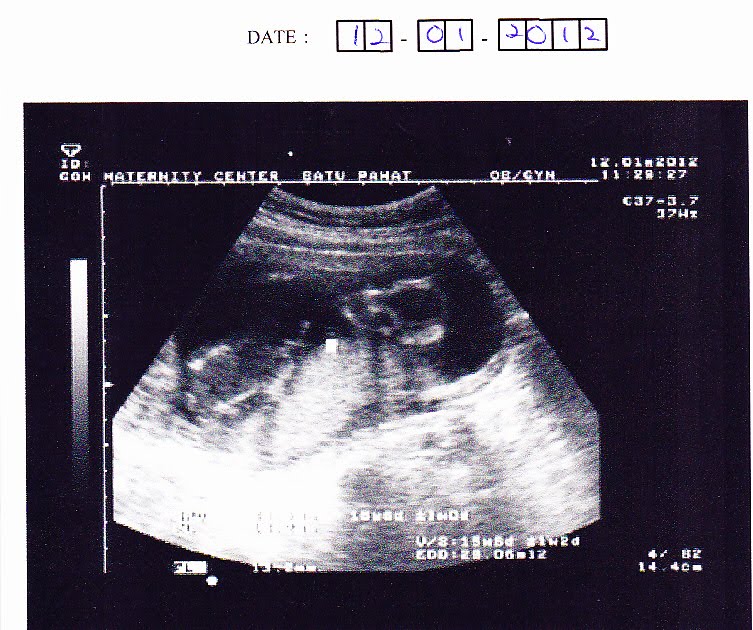Scan at 16 weeks