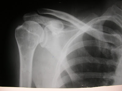 X-rays and Slides: Simple bone cyst in the proximal humerus