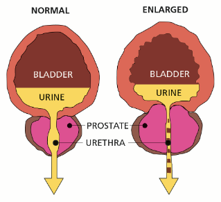 Benigna Prostat Hyperplasia (BPH) - KajianPustaka