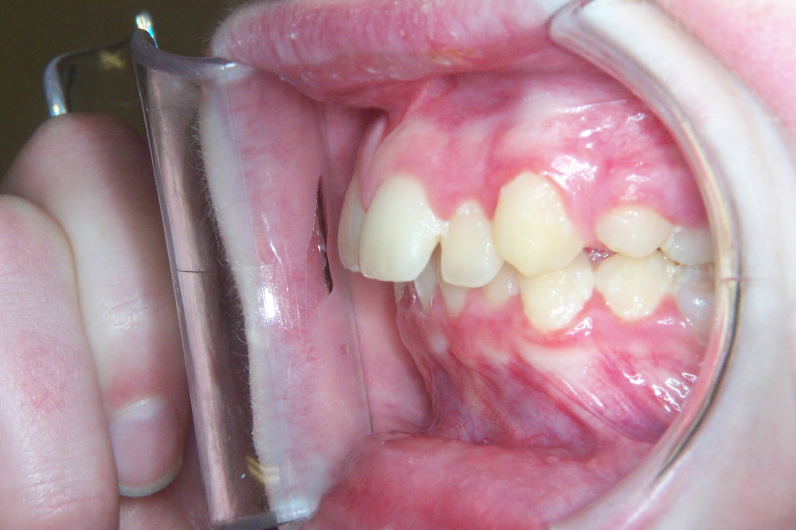 Truman Orthodontics Teenager With Dental Crowding And Overbite