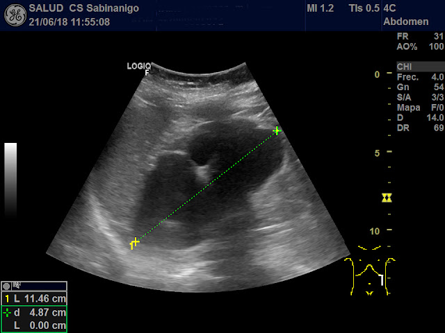 Ecografía en Atención Primaria: GRAN HIDRONEFROSIS en estudio