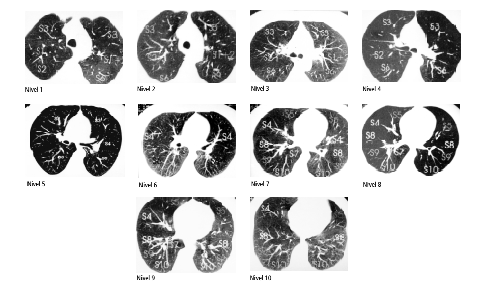 Anatomía Normal de la vía aérea y la segmentación pulmonar por ...