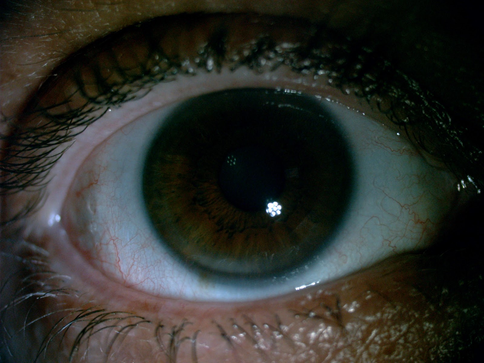 Vernon's Vision: CORNEAL ARCUS