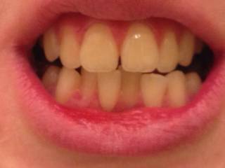 Laura's Jaw Surgery: February 2012