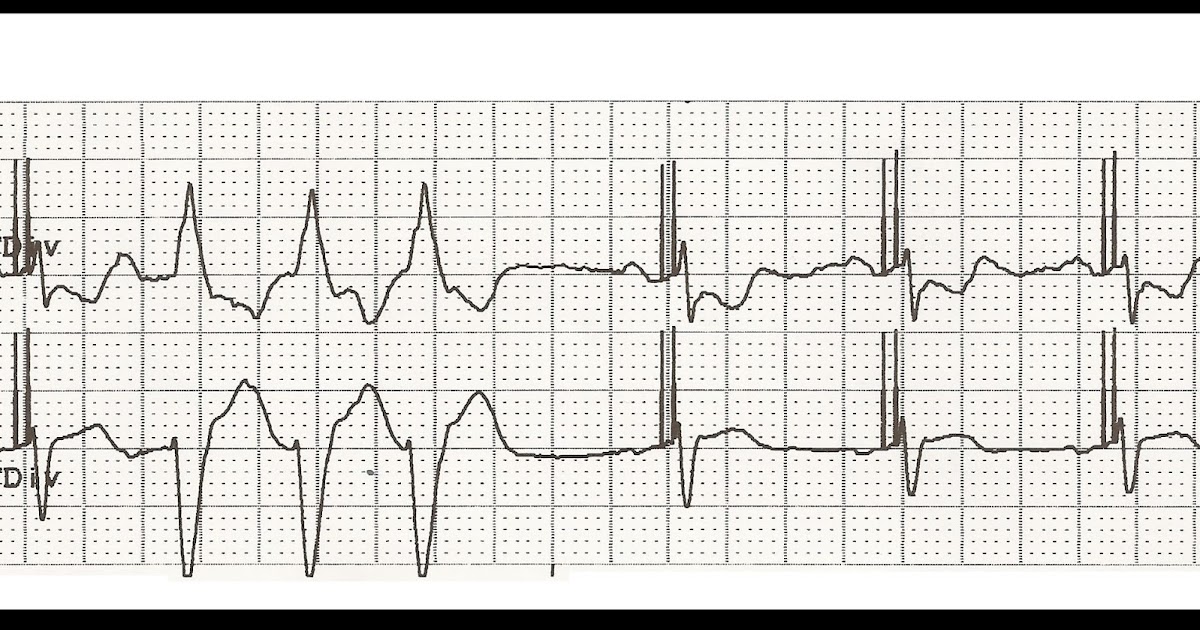 EKG Quiz 320