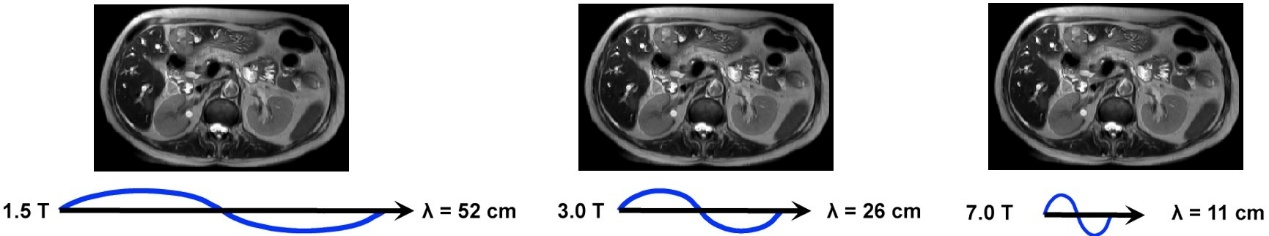 Radiology Community: Dielectric shading artifacts in high field ...