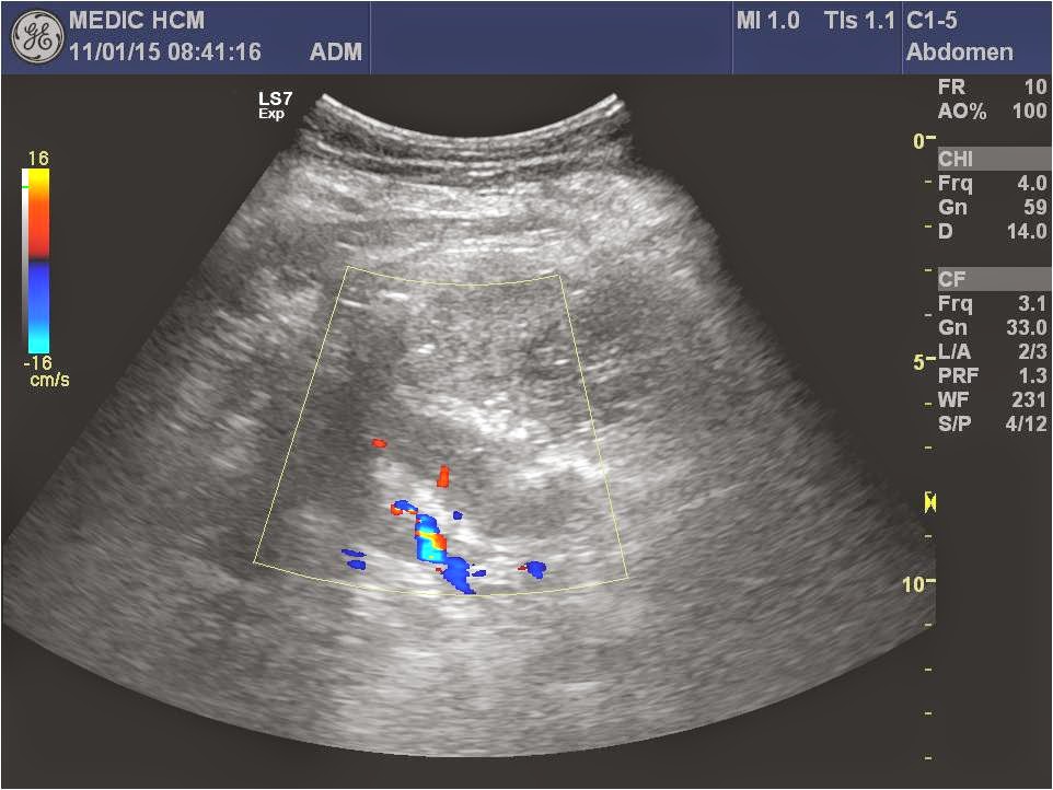 VIETNAMESE MEDIC ULTRASOUND: CASE 293: KIDNEY ABSCESS, Dr PHAN THANH ...