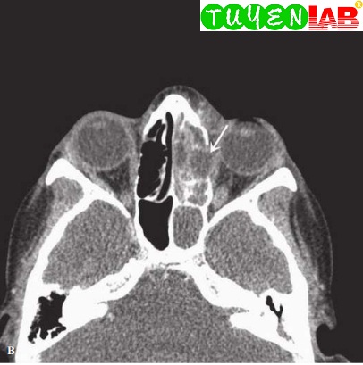 [Pediatric] Atlas of Orbital cellulitis | Free Medical Atlas