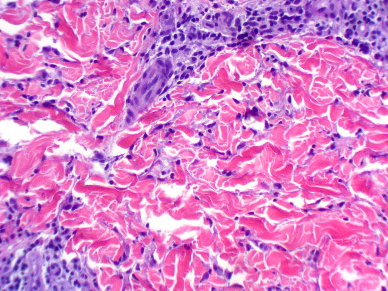 VIRTUAL GRAND ROUNDS IN DERMATOLOGY 2.0: Interstitial Granulomatous ...