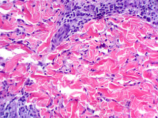 VIRTUAL GRAND ROUNDS IN DERMATOLOGY 2.0: Interstitial Granulomatous ...