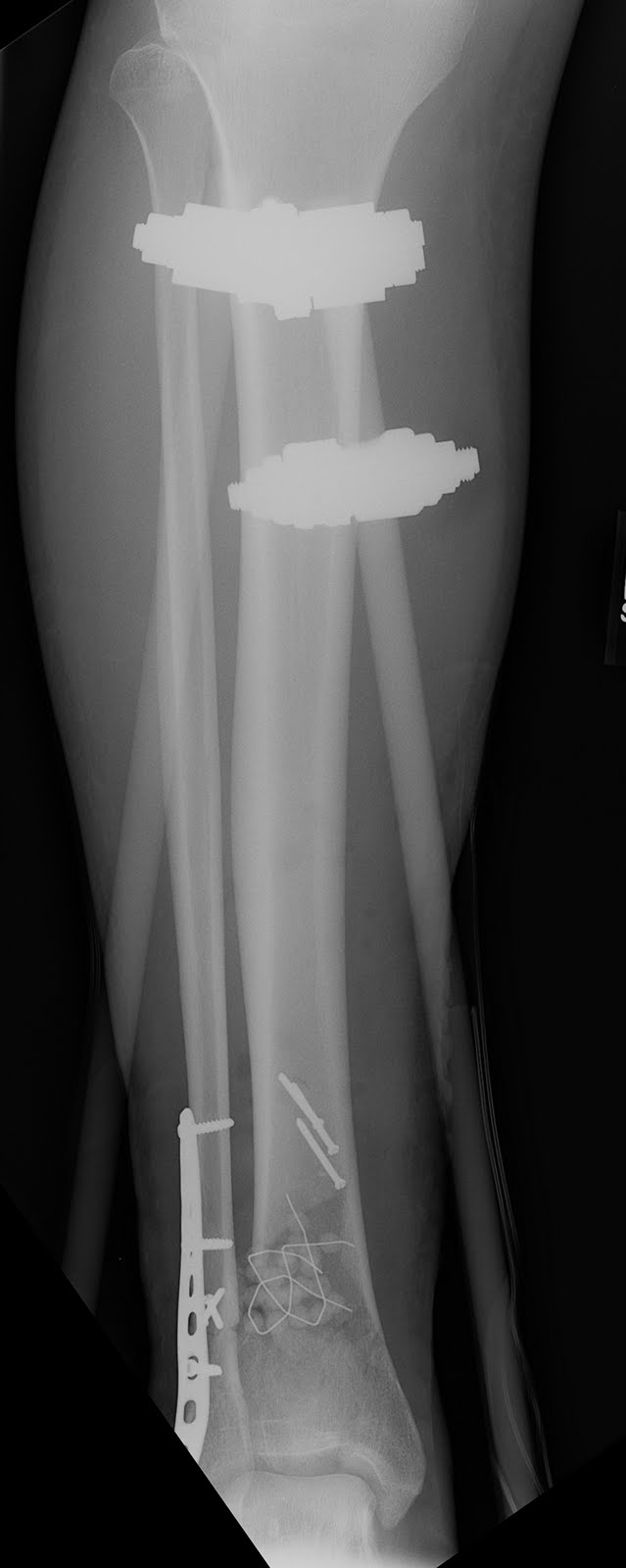 Case of the Month: Fracture cases at Harborview Medical Center ...
