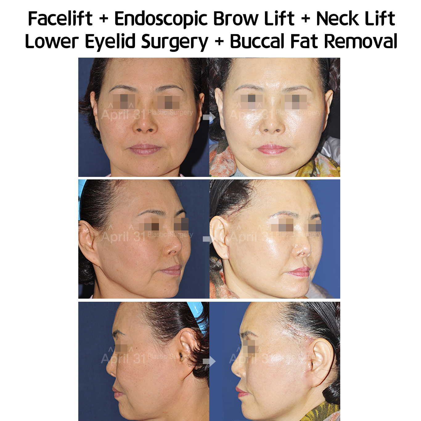 April31 Plastic Surgery Clinic: Facelift + Endoscopic Brow Lift + Neck ...
