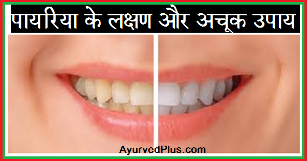 पायरिया के लक्षण और इसके अचूक उपाय - आयुर्वेदप्लस | AyurvedPlus.com