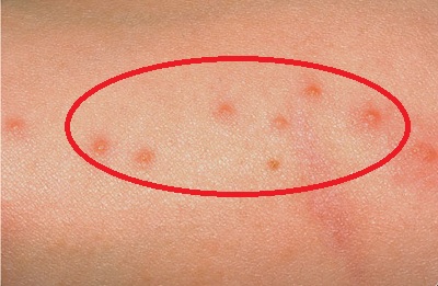 Gamot Sa Peklat Na Kagat Ng Surot