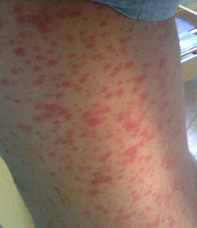 DHIVIDIR PARA MULTIPLICAR: Caso 45- homem, exantema morbiliforme após ...