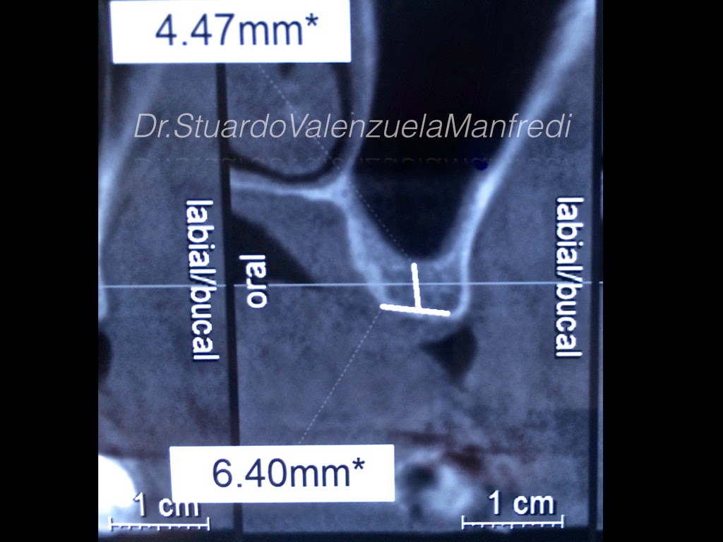 Elevación de Seno Maxilar con Ventana Lateral (técnica clásica)