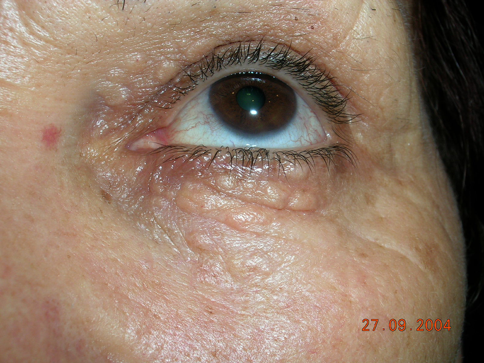 Xantelasma
