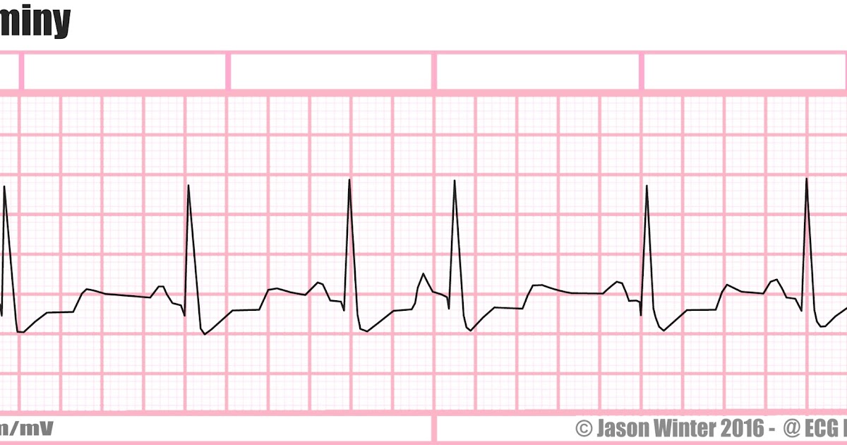 ECG Educator Blog : Atrial Trigeminy