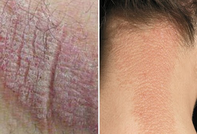 Go Go Healthy Everyone!: 6 JENIS EKZEMA DAN CARA MENGATASINYA