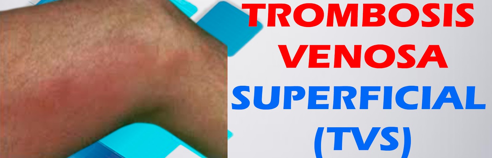 Trombosis Venosa Superficial | GLOMACH MEDIC VARICES