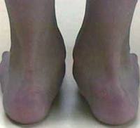 MMII - REHABILITACION: Deformidades del pie y del tobillo.