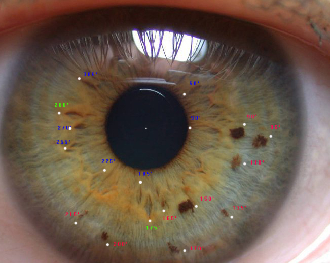 Modern & Multidimensional Iridology: Dyscratic Diathesis, Central ...