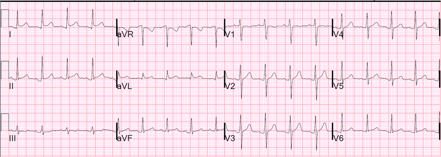 Dr. Smith's ECG Blog: June 2013
