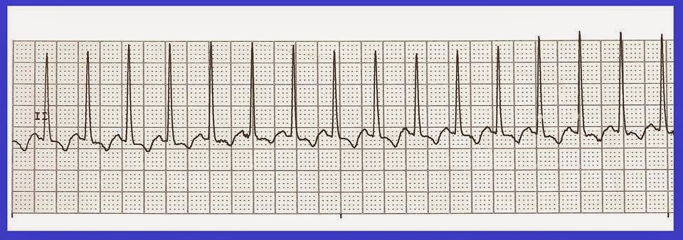 Various Sinus Tachycardias