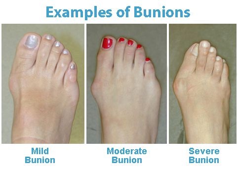 The Health Website : Bunions
