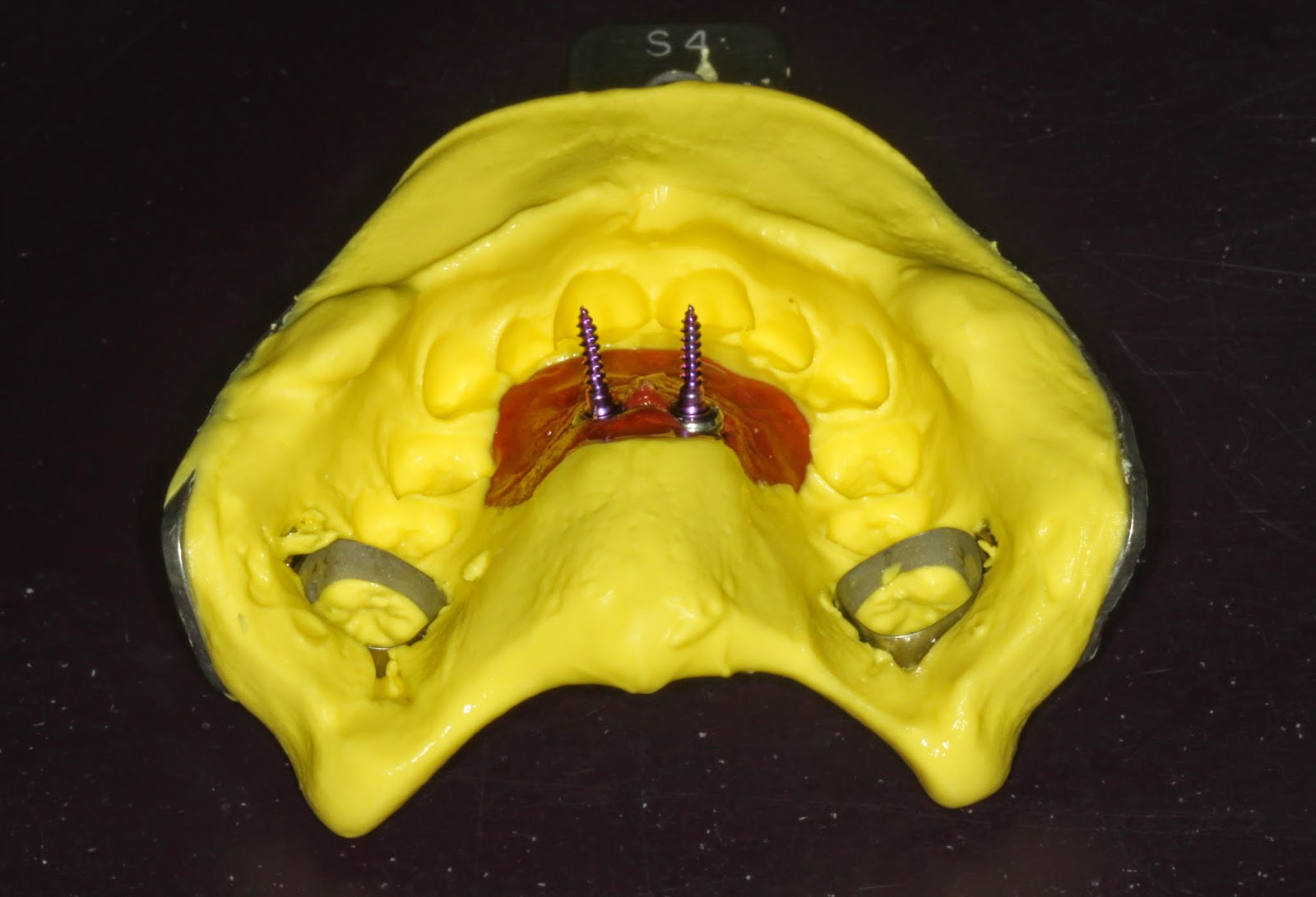 Orthodontic Thoughts: Technique for Almost Painless Palatal Anesthesia