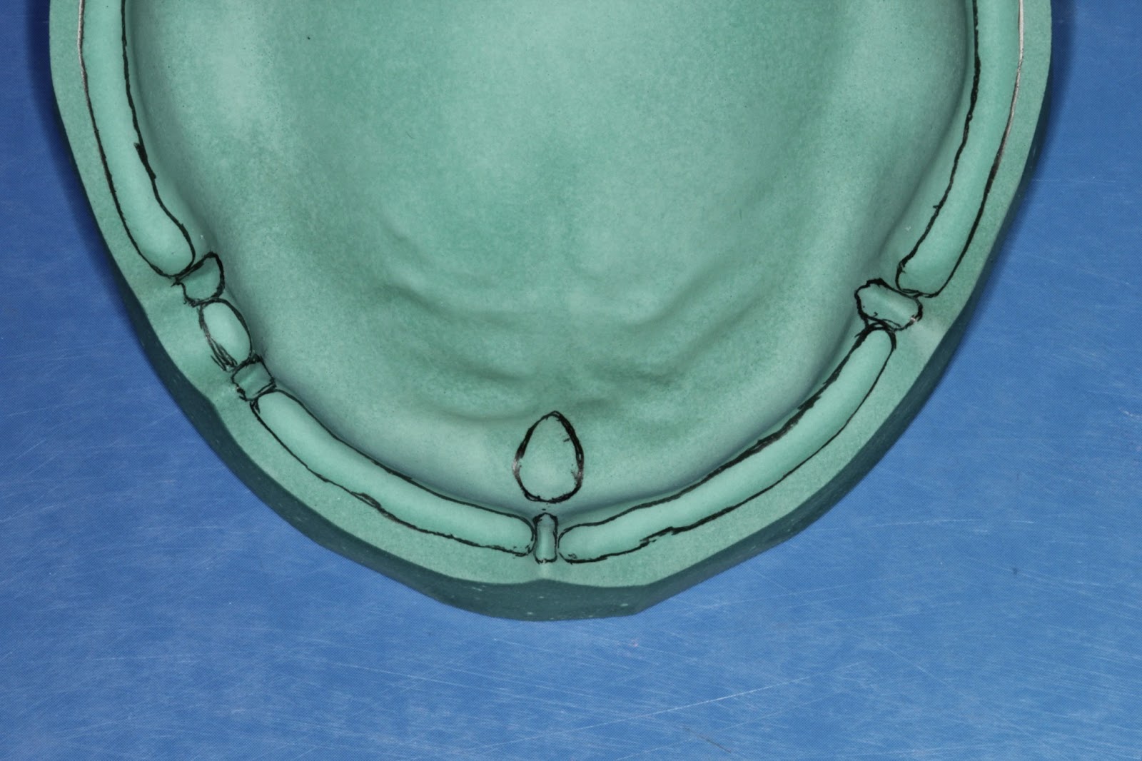 Understanding Prosthodontics - Tagore Dental College & Hospital-By ...