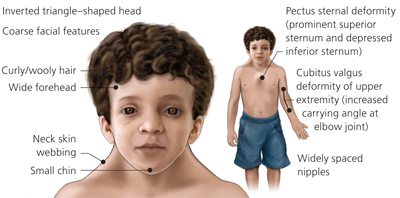 Síndrome de Noonan | Medicusmeo