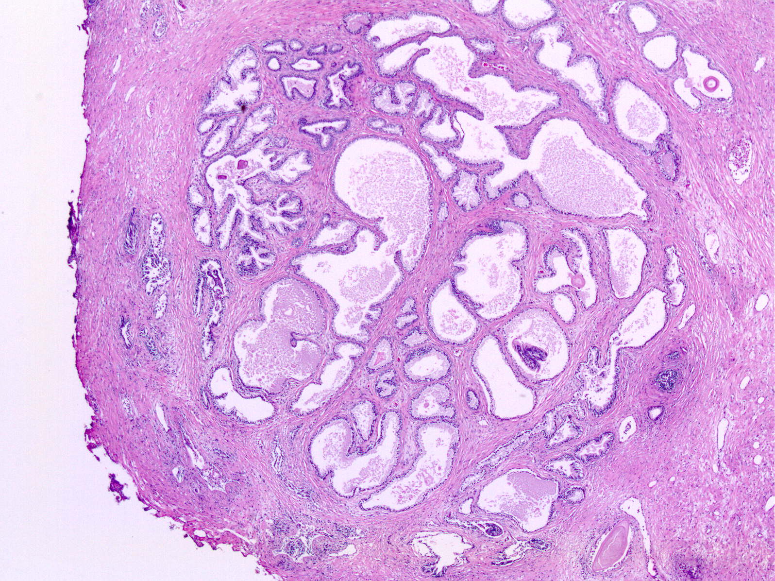 Histopatologando - Atlas do HCFMRP-USP: Hiperplasia Prostática Benigna