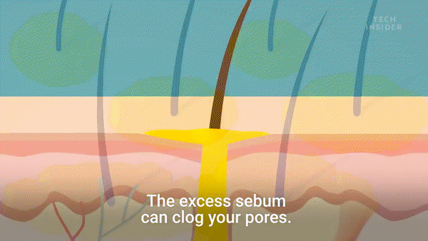 Angel Belle Faith: Don't Let Acne Take Away Your Life! #ad #davinciclinic