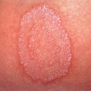 Diseases Treatment: Tinea Treatment