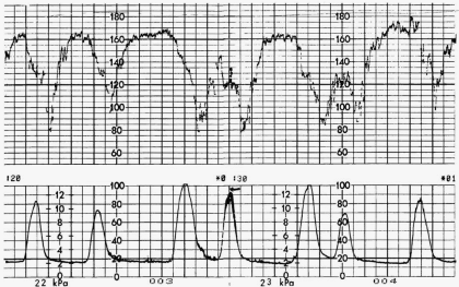 học Y: monitoring sản khoa (CTG