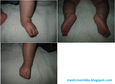Human skeleton anatomy: Congenital Talipes Equinovarus Clubfoot