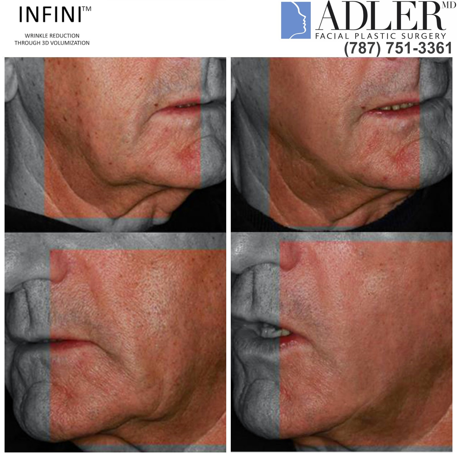 Rejuvenecimiento con Infini en Adler Facial |Levantamiento Facial ...