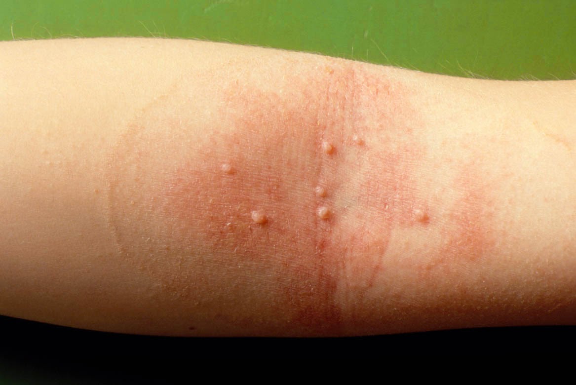 Molluscum Contagiosum Virus Infection - Health Article