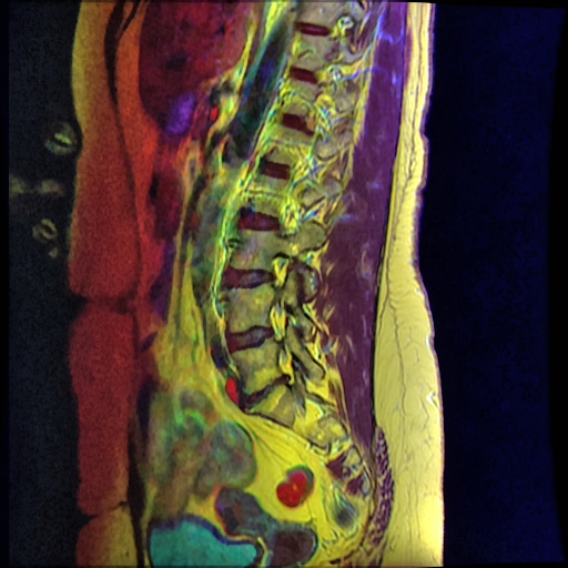 Nevit's blog: Color MRI of the Lumbar vertebrae