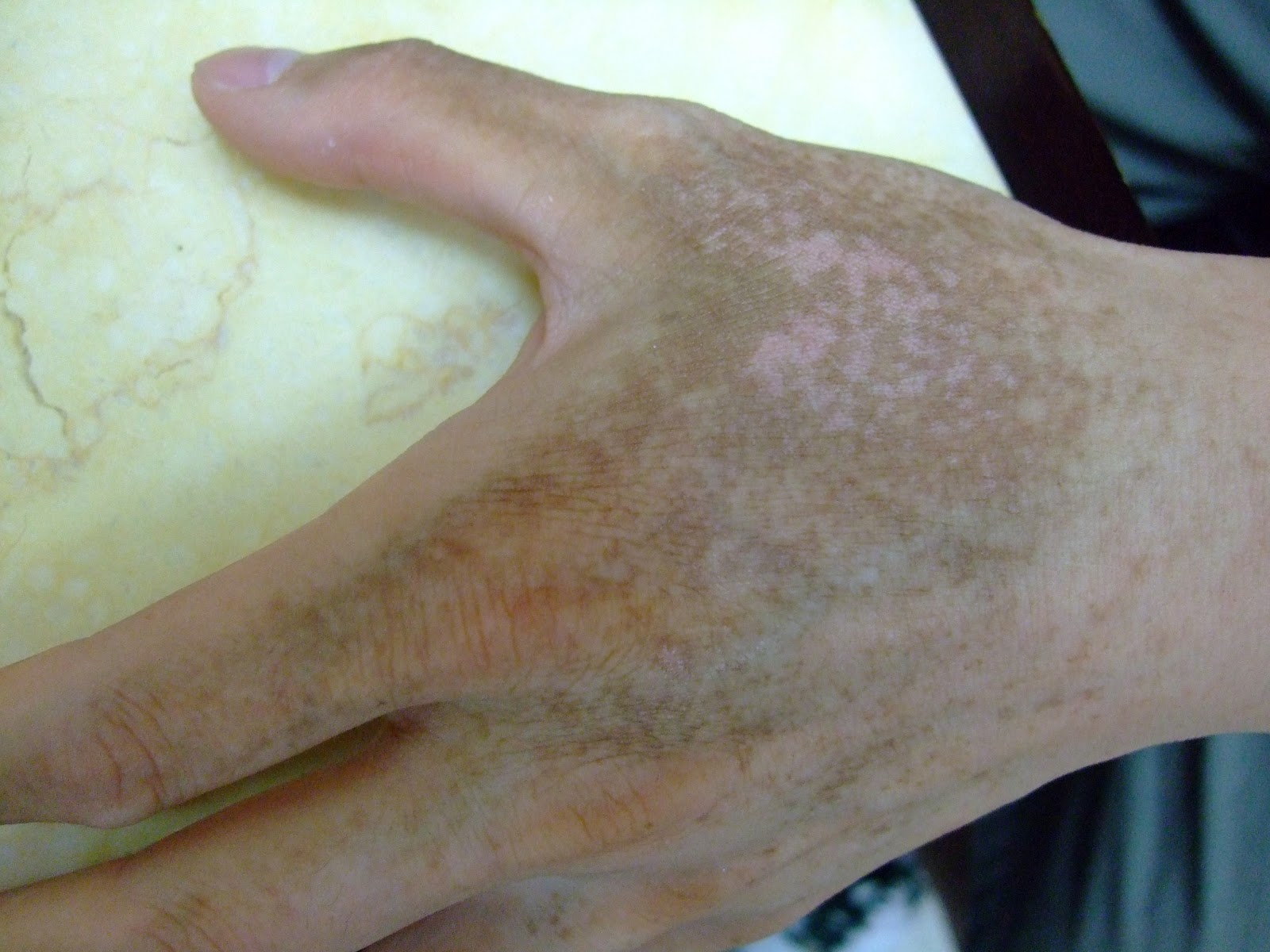 可觀焉-謝志偉皮膚科醫師的筆記: 每個壞蛋都是檸檬-植物光照性皮膚炎（phytophotodermatitis), 檸檬汁皮膚炎