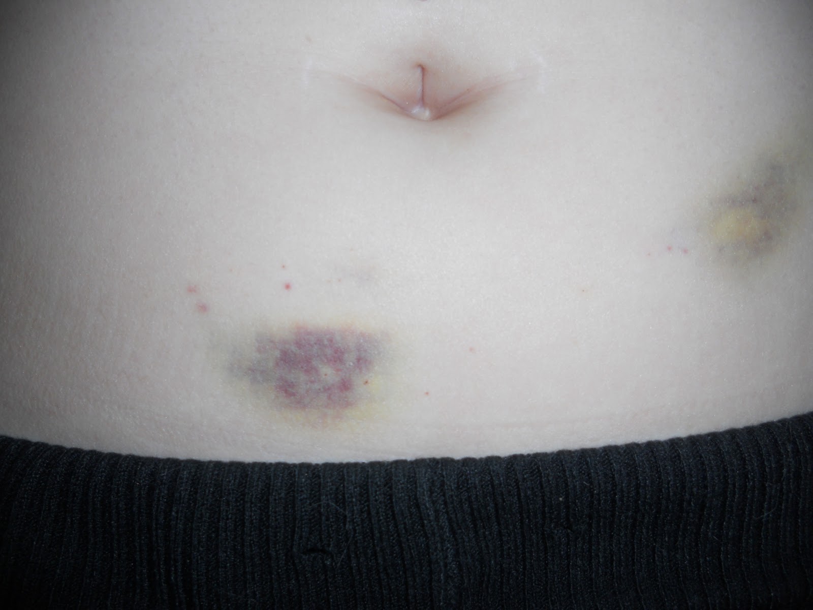 Poly what?: Thanksgiving and needle tracks