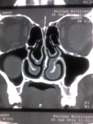 ENT Surgeon's blog: Concha Bullosa