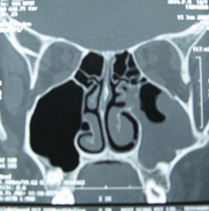 CT/MRI: Sinusitis
