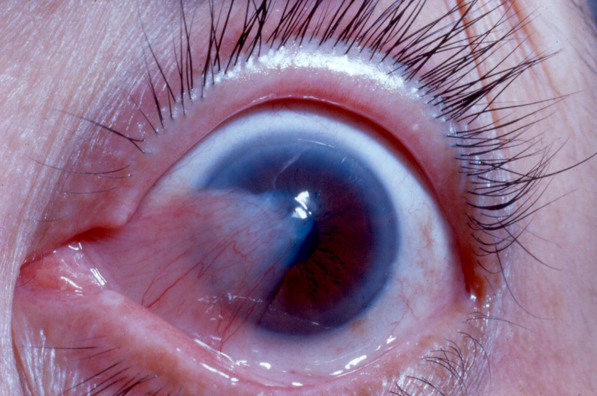 Images For Pterygium ~ YOUNG DOCTORS' RESEARCH FORUM