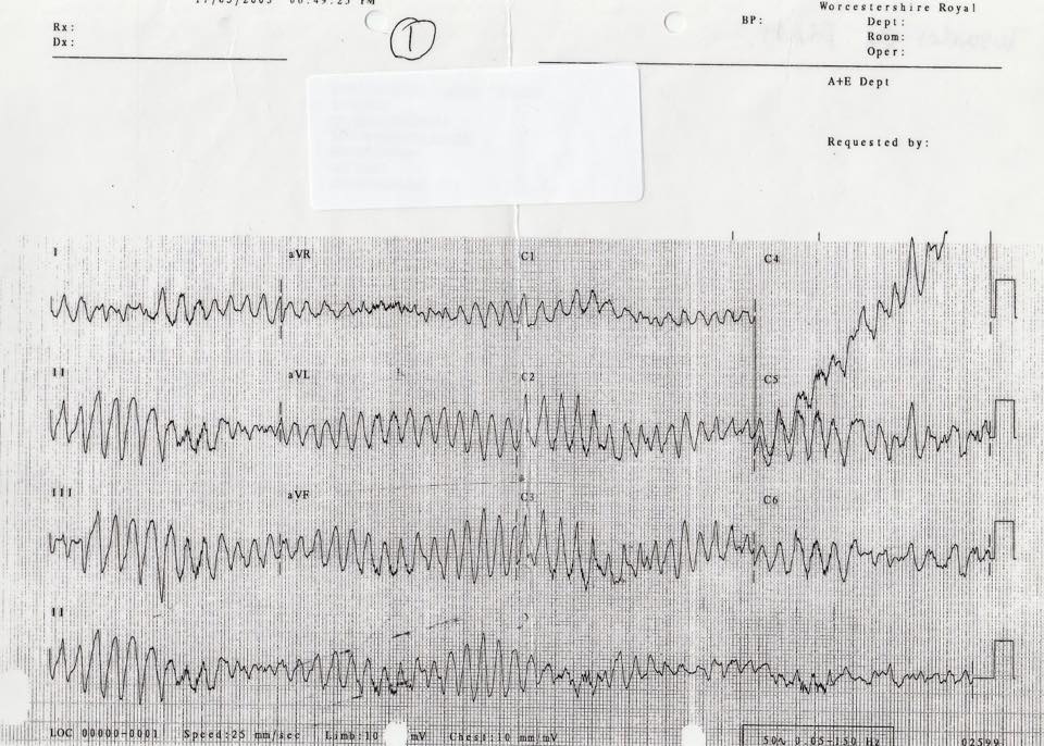 Clinical Electrocardiology ECG Blog: 2016