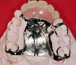 TRATAMIENTOS DENTALES: Prótesis Dental Parcial Removible