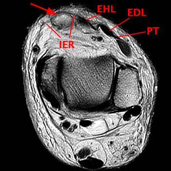 Peroneus Tertius Mri