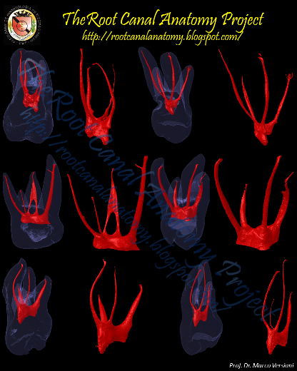 The Root Canal Anatomy Project: Four-Rooted Maxillary Second Molars