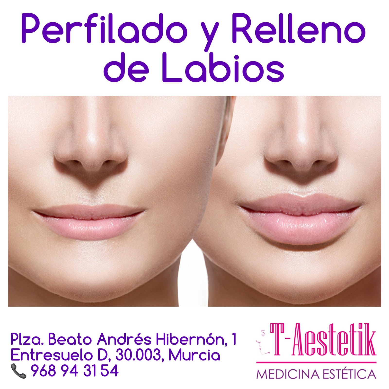 Blog de T-Aestetik: Diferencia entre Relleno y Perfilado de Labios